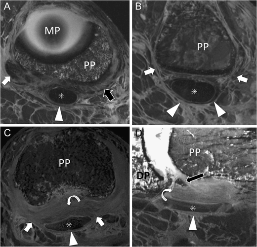 Magnetic resonance imaging of the pulleys of the flexor tendons of the ...