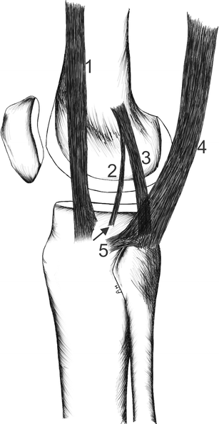 Segond fracture: involvement of the iliotibial band, anterolateral ...