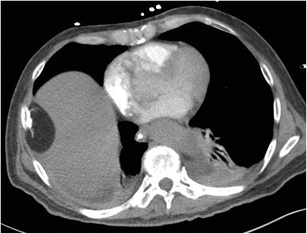 Incidental imaging finding of chest wall mass | SpringerLink