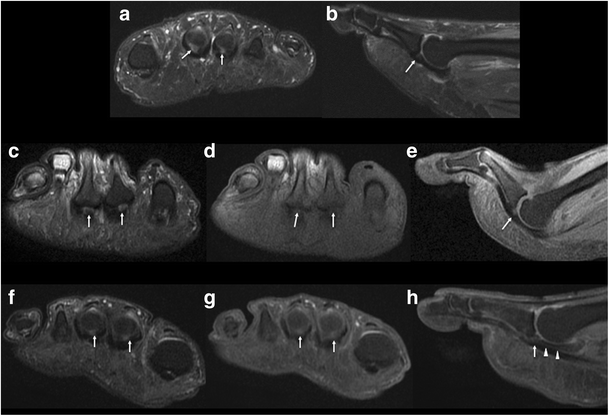 Evaluation of lesser metatarsophalangeal joint plantar plate tears with ...
