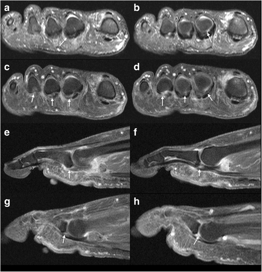 Evaluation of lesser metatarsophalangeal joint plantar plate tears with ...