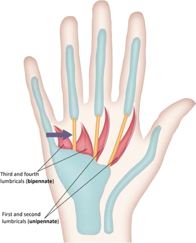 Ring finger lumbrical origin strain: a case series with imaging ...