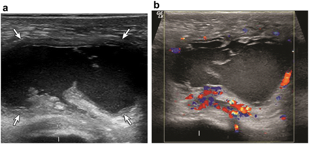 Ultrasound evaluation of bursae: anatomy and pathological appearances ...