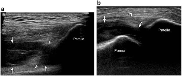 Ultrasound evaluation of bursae: anatomy and pathological appearances ...