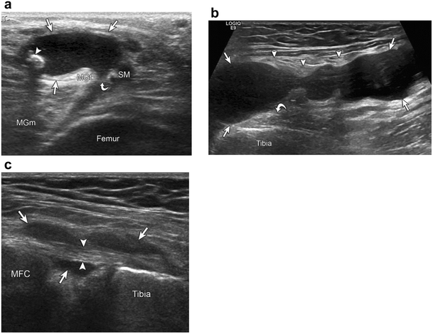 Ultrasound evaluation of bursae: anatomy and pathological appearances ...