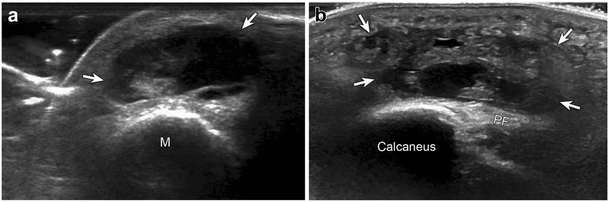 Ultrasound evaluation of bursae: anatomy and pathological appearances ...