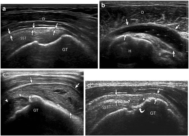 Ultrasound evaluation of bursae: anatomy and pathological appearances ...