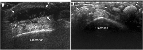 Ultrasound evaluation of bursae: anatomy and pathological appearances ...