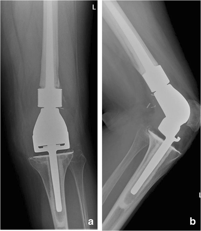 Metal wear-induced pseudotumour following an endoprosthetic knee ...