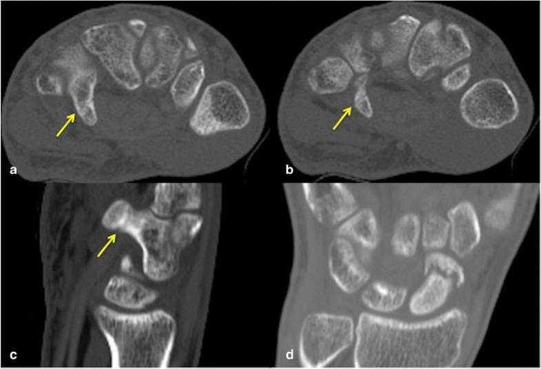 Concomitant hook of hamate fractures in patients with scaphoid fracture ...