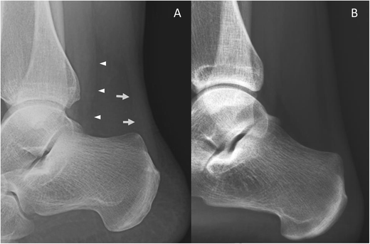 Isolated rupture of the accessory soleus tendon: an original and ...