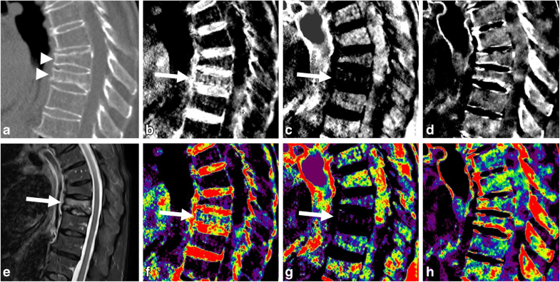 Three-material decomposition with dual-layer spectral CT compared to ...