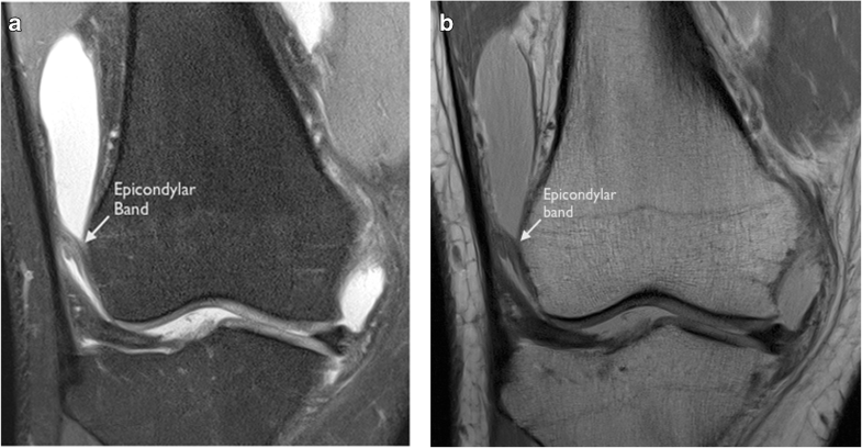 Magnetic resonance imaging appearances of the capsulo-osseous layer of ...