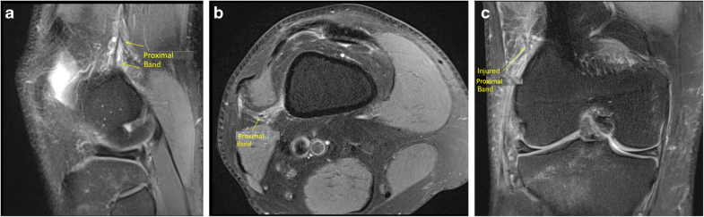 Magnetic resonance imaging appearances of the capsulo-osseous layer of ...