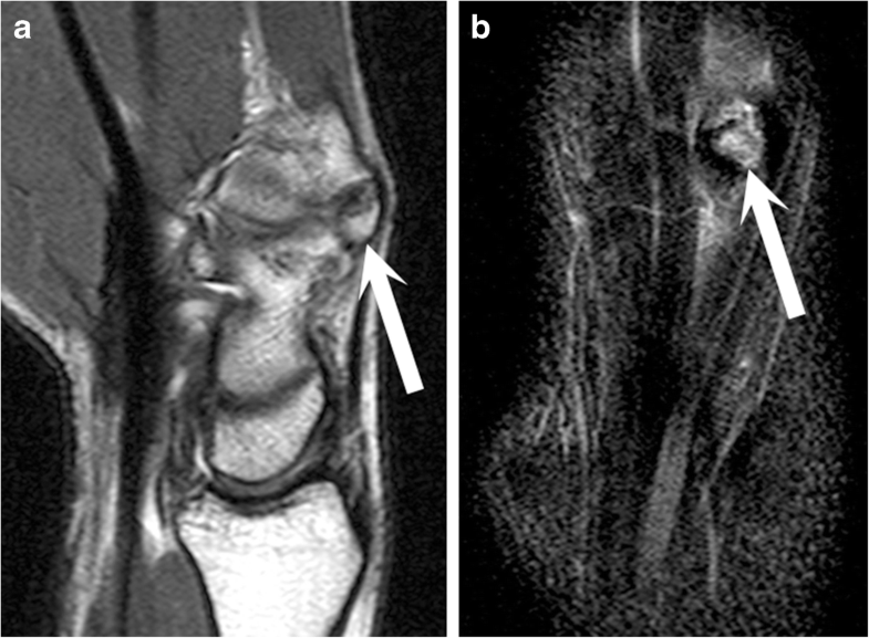 MRI of a painful carpal boss: variations at the extensor carpi radialis ...