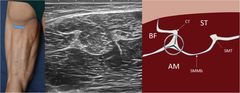 Sonographic landmarks in hamstring muscles | SpringerLink