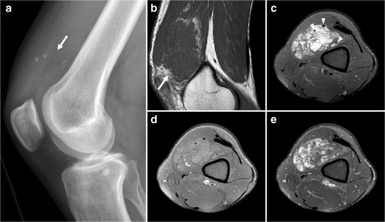 Calcified or ossified benign soft tissue lesions that may simulate ...