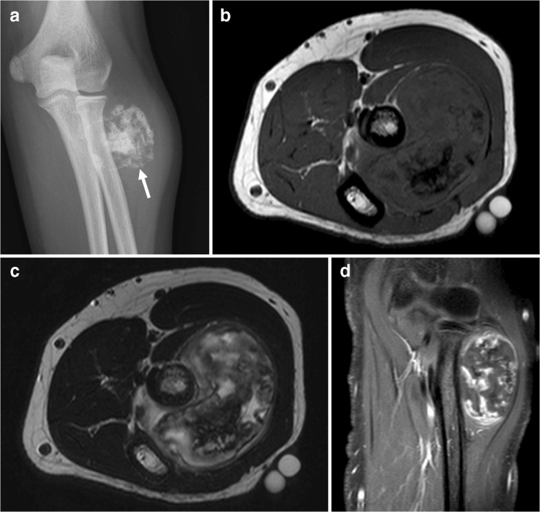 Calcified or ossified benign soft tissue lesions that may simulate ...