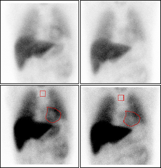 Nuclear imaging in cardiac amyloidosis | SpringerLink