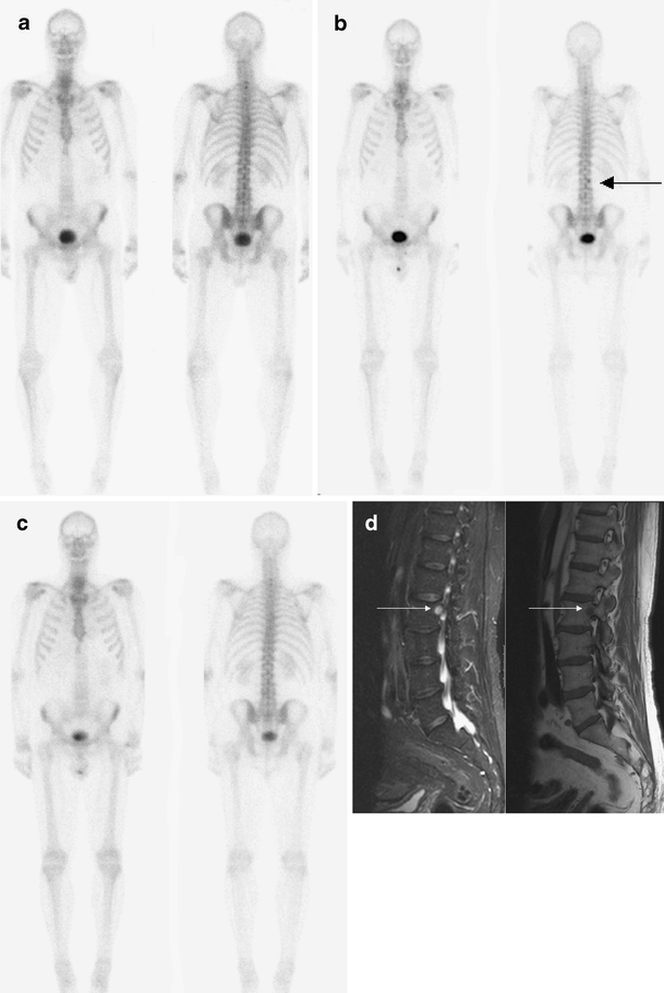 The diagnostic utility of the flare phenomenon on bone scintigraphy in ...
