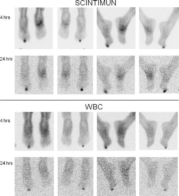 99mTc-besilesomab (Scintimun®) in peripheral osteomyelitis: comparison ...