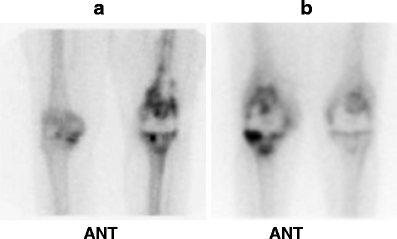 Prosthetic joint infections: radionuclide state-of-the-art imaging ...