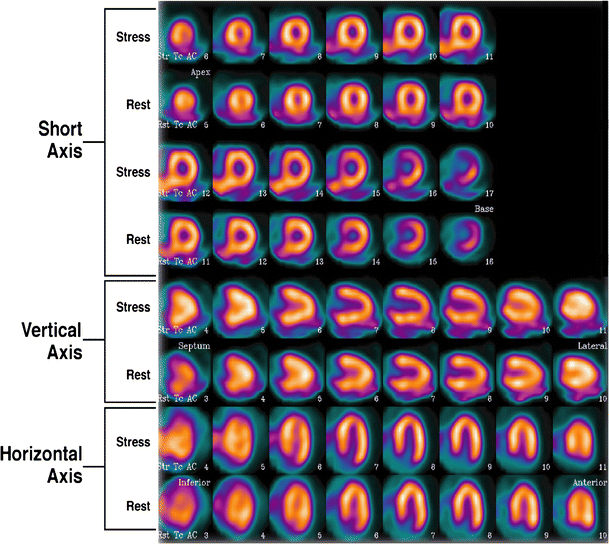 Very high coronary artery calcium score with normal myocardial ...