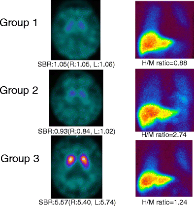 Utility of the combination of DAT SPECT and MIBG myocardial ...