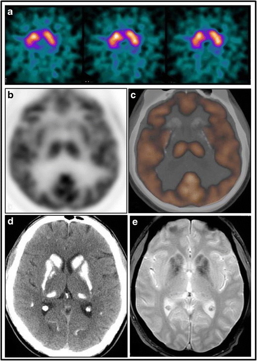 A case of Fahr’s disease examined by multi-modal imaging | SpringerLink