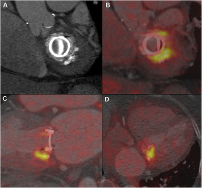 Recurrent prosthetic mitral valve infective endocarditis and ...
