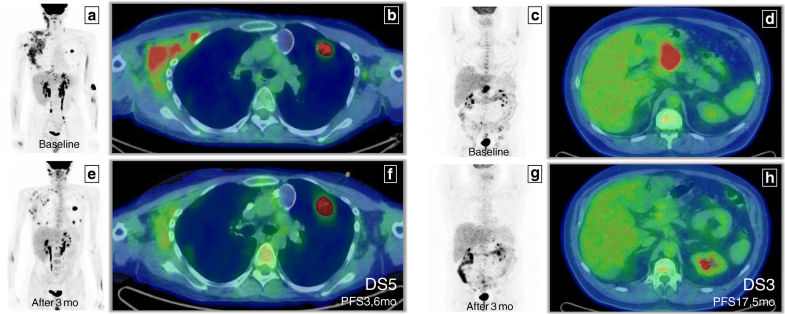 Deauville score: the Phoenix rising from ashes | SpringerLink