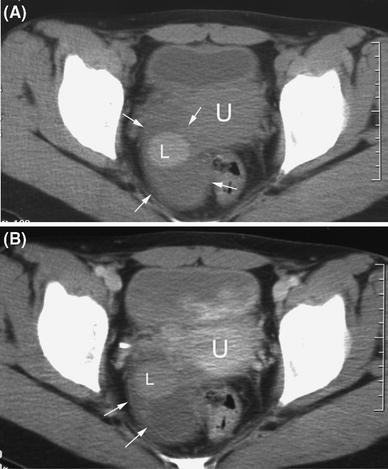 Struma ovarii: CT findings | SpringerLink