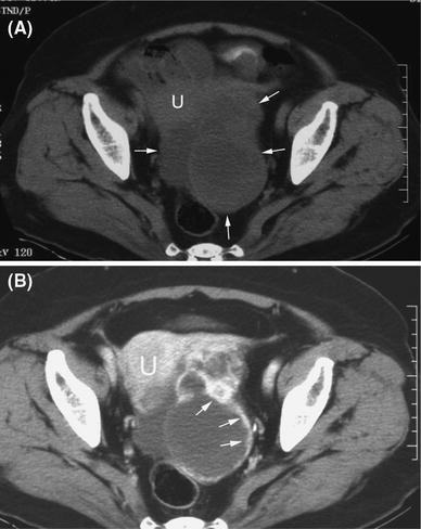 Struma ovarii: CT findings | SpringerLink