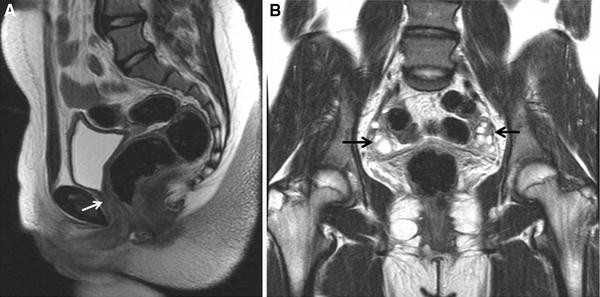Mullerian duct anomalies: MR imaging | SpringerLink