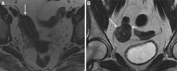 Mullerian duct anomalies: MR imaging | SpringerLink