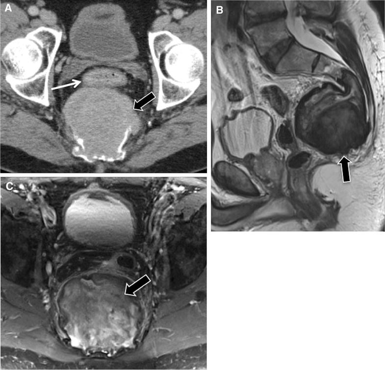 Benign and malignant tumors of the rectum and perirectal region ...