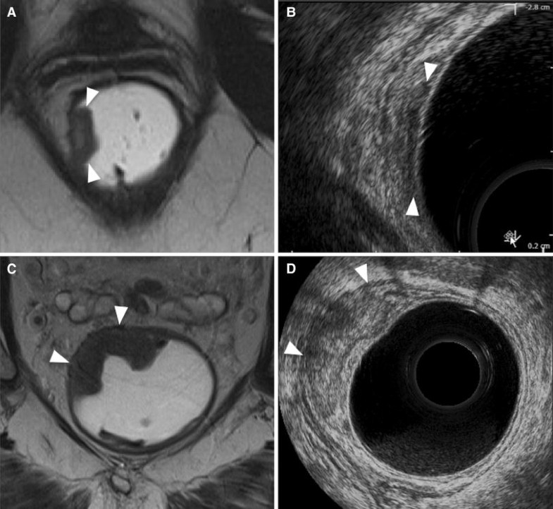 Benign and malignant tumors of the rectum and perirectal region ...