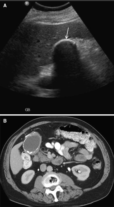 The gallbladder: uncommon gallbladder conditions and unusual ...