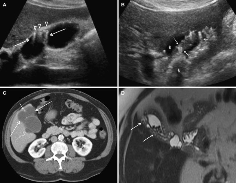 The gallbladder: uncommon gallbladder conditions and unusual ...