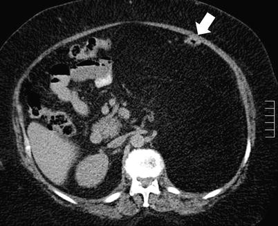 Primary retroperitoneal masses: what is the differential diagnosis ...
