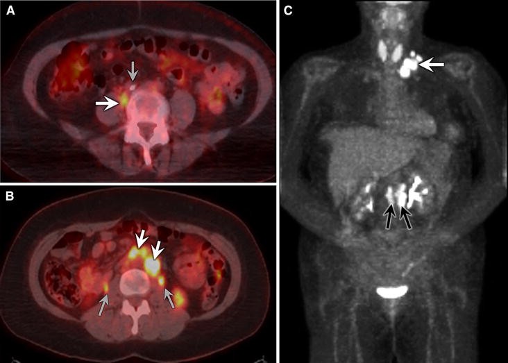 PET/CT and MRI in the imaging assessment of cervical cancer | SpringerLink