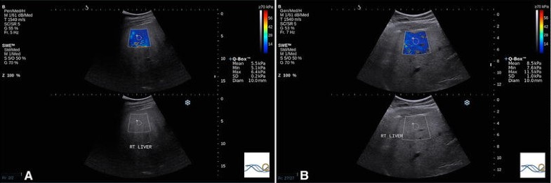 Ultrasound elastography: liver | SpringerLink