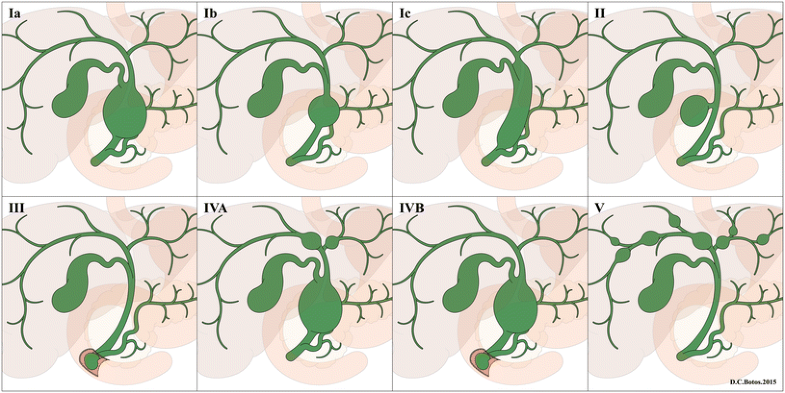 Imaging of choledochal cysts | SpringerLink