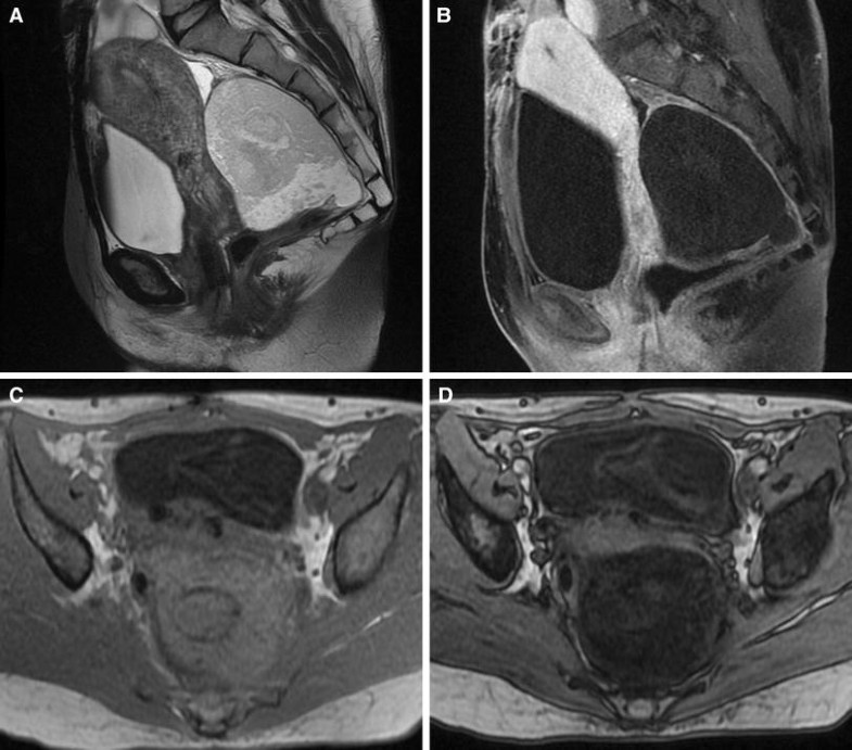 MR imaging of the retrorectal–presacral tumors: an algorithmic approach ...
