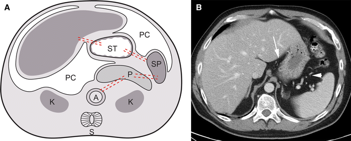 The subperitoneal space and peritoneal cavity: basic concepts ...