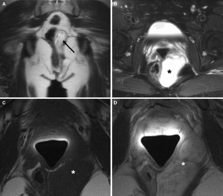 Imaging of tailgut cysts | SpringerLink