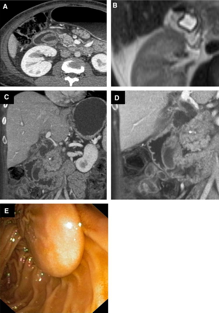 MDCT and MRI of the ampulla of Vater (part II): non-epithelial ...