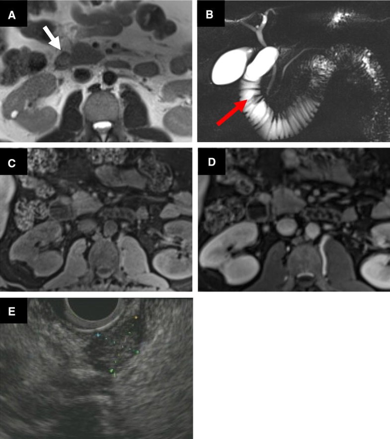 MDCT and MRI of the ampulla of Vater (part II): non-epithelial ...