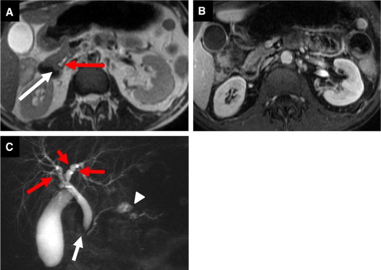 MDCT and MRI of the ampulla of Vater (part II): non-epithelial ...