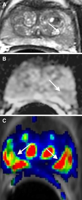 Benign causes of diffusion restriction foci in the peripheral zone of ...